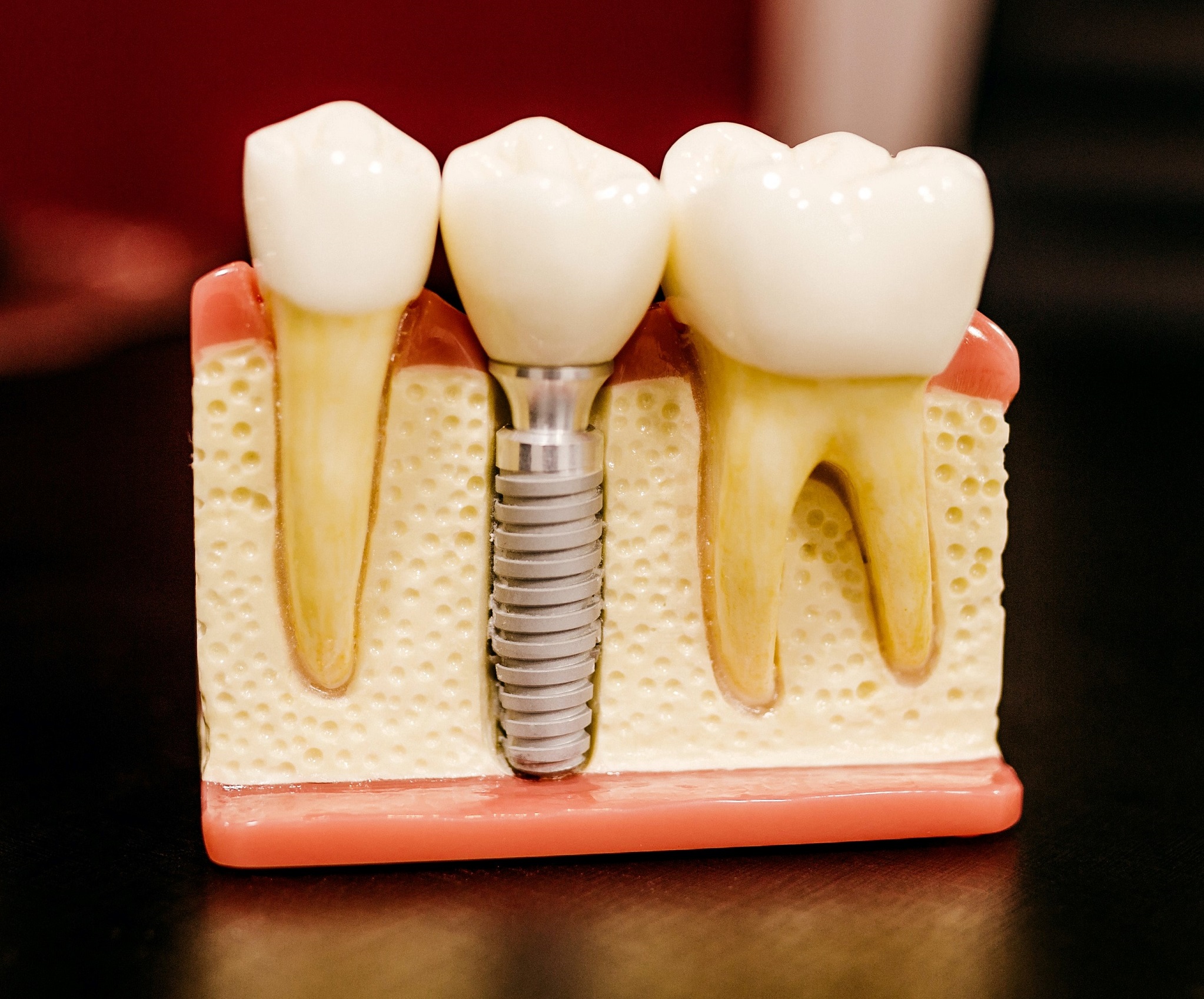 Dental Implants | Dr. Neetika Shukla